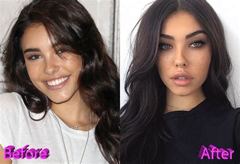 Madison Beer Plastic Surgery Lips And Fillers Bvmem
