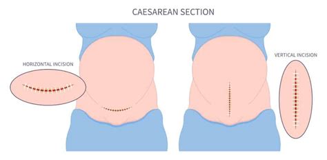 Everything You Need To Know About The C Section Procedure