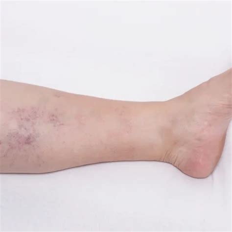 Docteur360 Insuffisance Veineuse