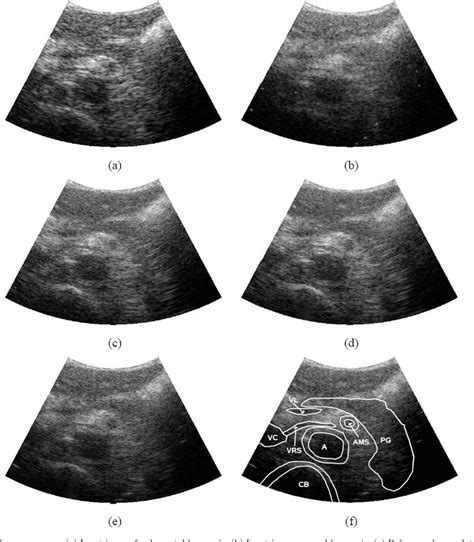 Figure 3 From Two Dimensional Blind Bayesian Deconvolution Of Medical Ultrasound Images
