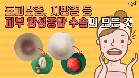 피부 혹 제거해야 할까요 오체안성형외과 이용석 원장의 양성종양 이야기 표피낭종 피지낭종 지방종 이마지방종 피부섬유종 Youtube
