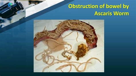 Soil Transmitted Helminths Pptx