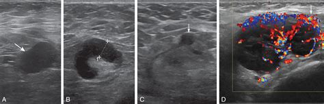 Lymph Node Evaluation In Breast Imaging Clinical Tree