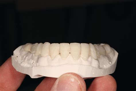 How To Use A Single Shade Composite System In An Indirect Application