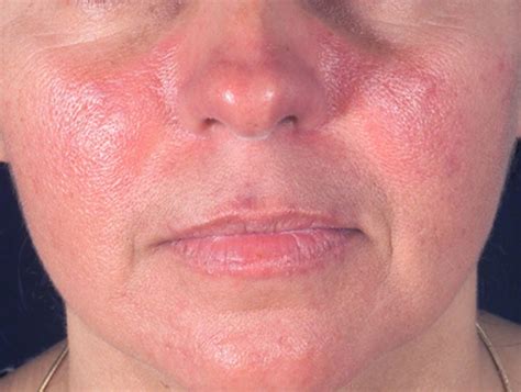 Photodermatitis Pictures Treatment Symptoms And Causes 2018