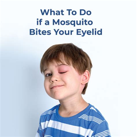 What To Do If Mosquito Bite Eye At Kevin Davidson Blog