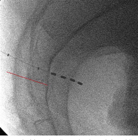 Figure 3 From Peripheral And Sacral Neuromodulation In The Treatment Of