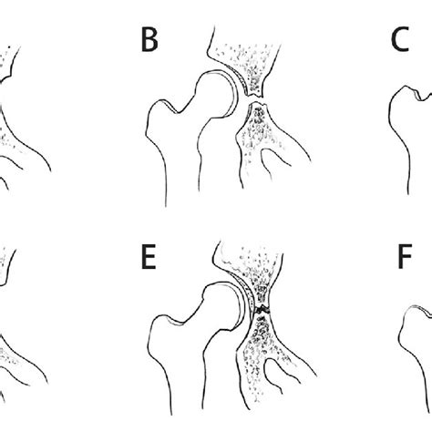 Modified Bucholz Classification A Normal B Type I C Type Ii D Type