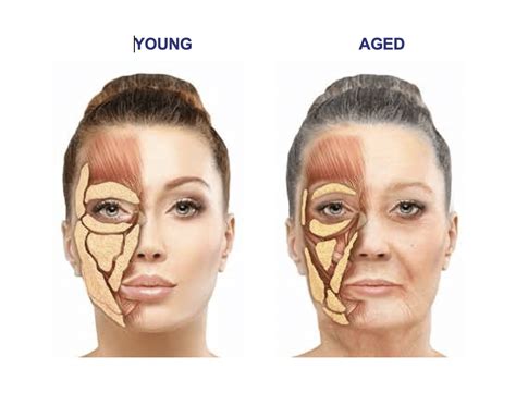 Effet Liftant : Découvrez Profhilo Structura pour un Visage Rajeuni