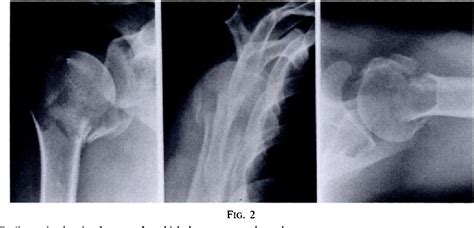 Figure 1 From The Neer Classification System For Proximal Humeral