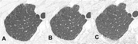 Figure 2 From Ultra Low Dose Ct Of The Thorax Using Iterative