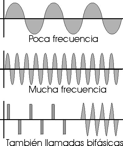Electroterapia Corrientes Más Utilizadas En Electroterapia