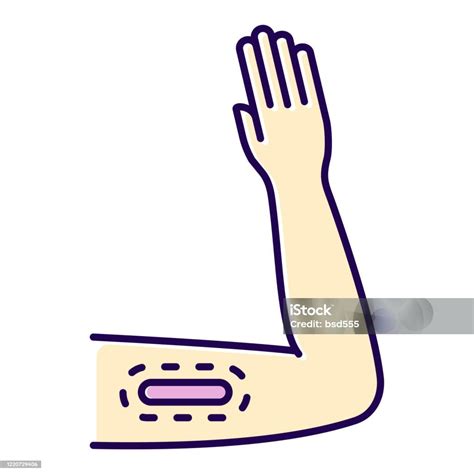 피임 임플란트 색상 아이콘 여성 방부제 방법 계획되지 않은 임신 예방 의료 절차로 피임 팔에 언더 스킨 입력 격리 벡터 일러스트레이션 임플란트에 대한 스톡 벡터 아트 및