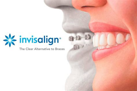 La ortodoncia invisible Invisalign, la alternativa perfecta a los brackets - Dicpas