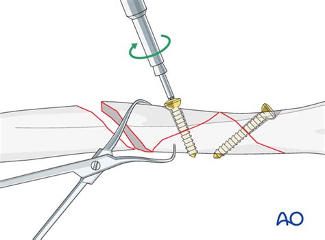 Orif Plate Fixation Proximal 1 3 For Multifragmentary Fracture Fragmentary Segment