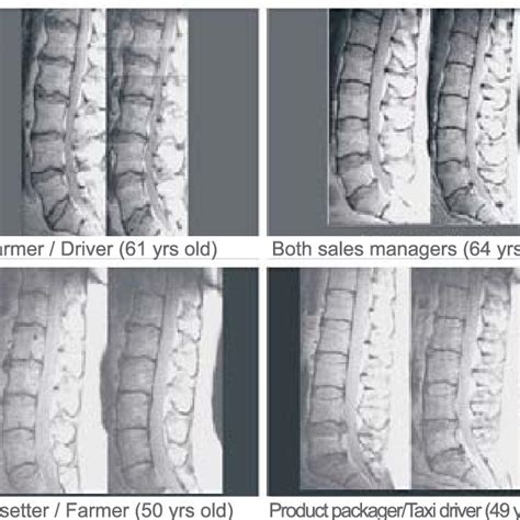 Benign Enlargement Of Subarachnoid Spaces In An Otherwise Healthy