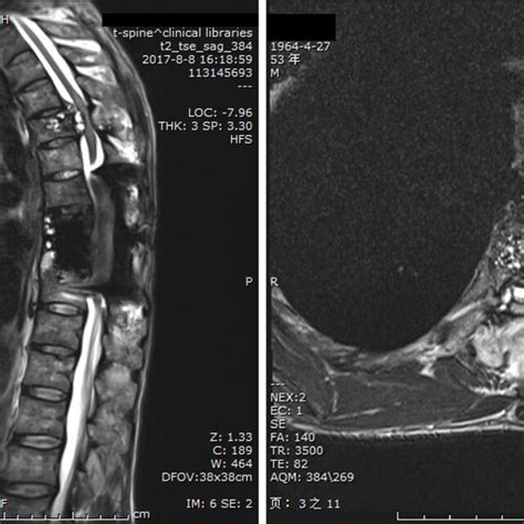 The Thoracic Magnetic Resonance Imaging In 2017 Shows Irregular