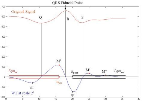 Detection Of Qrs Individual Waves And The Qrs Morphology It Shows A Download Scientific
