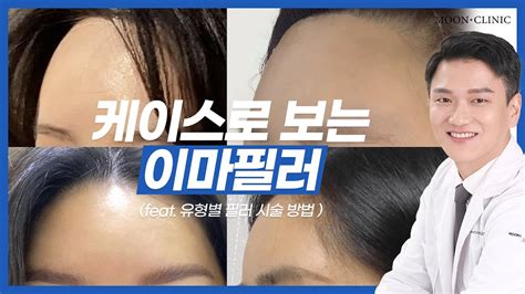 이마필러 케이스로 보는 유형별 시술법 문닥터스 Youtube