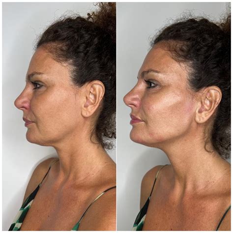 Cheek Filler Derma Aesthetics London