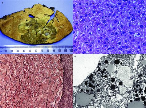 A Gross Right Hepatectomy Specimen Showing Centrally Placed Liver Download High
