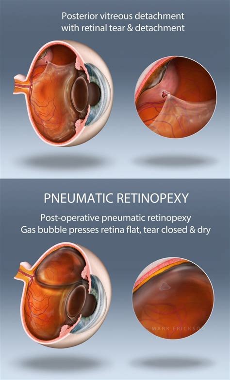 Pneumatic Retinopexy For Retinal Detachment Eye Surgery Eye Illustration
