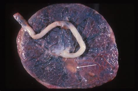 Chapter 4 Decidua Section C Breus Mole Subchorionic Thrombohematoma Fibrin Plaques And