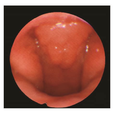 Adenoid Hypertrophy Grading System Used At West Virginia University For