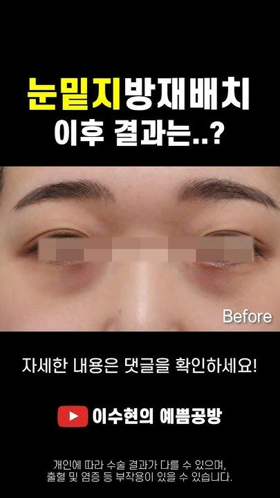 눈밑 쳐짐 수술 결과를 공개합니다 눈밑지방 눈밑꺼짐 리프팅 다크서클 눈밑지 눈밑지방재배치 눈밑지방제거 하안검 Youtube