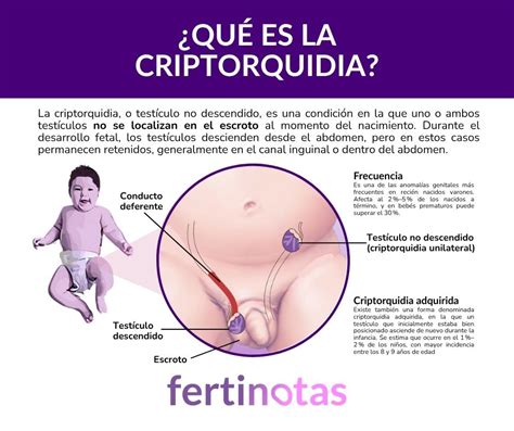 Criptorquidia Testículo No Descendido Y Su Relación Con La Fertilidad