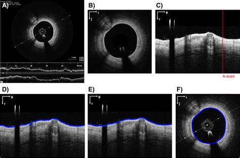 Example Of Lumen Detection Algorithm A Original Grayscale Oct Image B Download Scientific