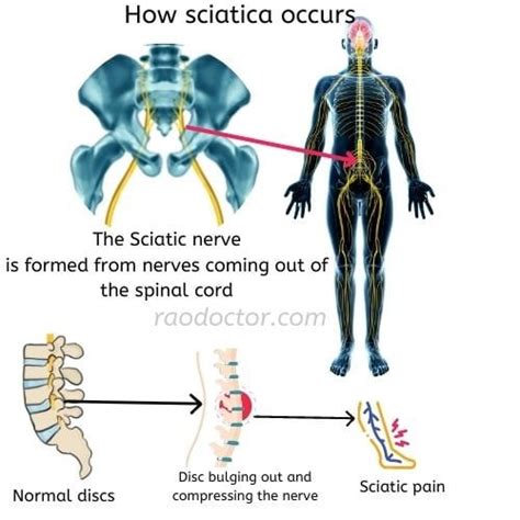 Backache Or Sciatica Learn How To Get Rid Of Your Pain