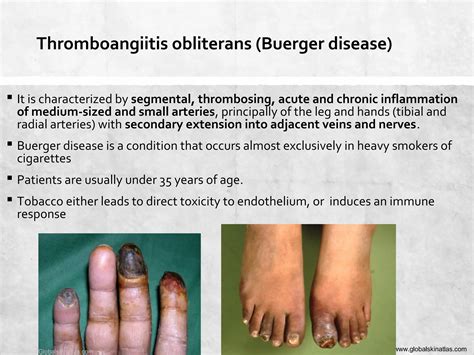 Cvs Pathology 6 Vasculitis 2019 Sufia Husain Ppt