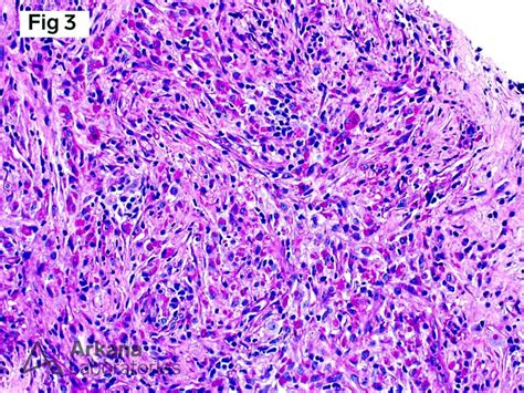 Malakoplakia Teaching Points Arkana Laboratories
