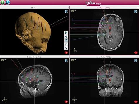 Stereoelectroencephalography Seeg Neurological Surgery University Of Pittsburgh Stereoelectroencephalography Seeg Neurological Surgery University Of Pittsburgh