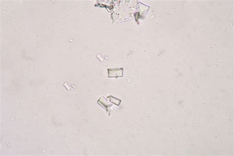 Cristales En Orina Qué Son Tipos Y Síntomas Tua Saúde