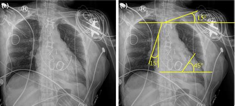 Temporary Pacemaker Chest X Ray At Leigh Clanton Blog