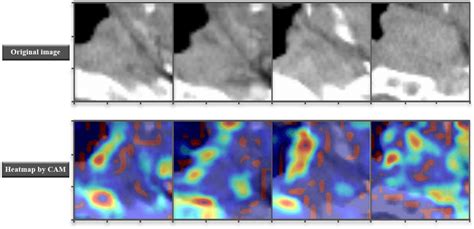 Feature Heatmaps Of Representative Patients On The Deep Learning