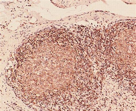 Bcl2 Ihc In Follicular Lymphoma