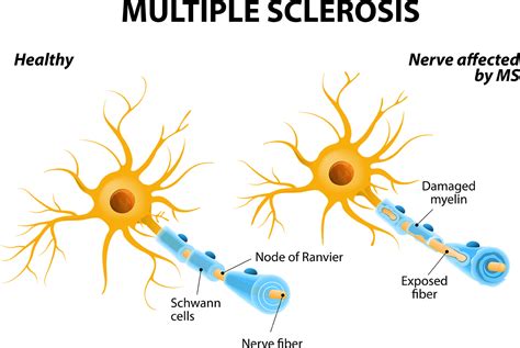 Early Signs Of Ms