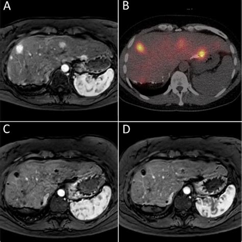 An Example Of A Patient With A Multifocal Recurrent Hepatocellular Download Scientific Diagram