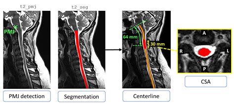 Cross Sectional Area Csa Spinal Cord Toolbox Documentation