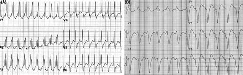 a svt with right bundle branch block morphology triphasic qrs