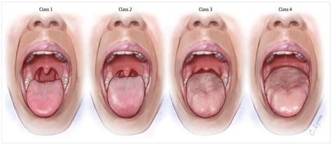 Sizing Up Those Tonsils Brown Med Peds