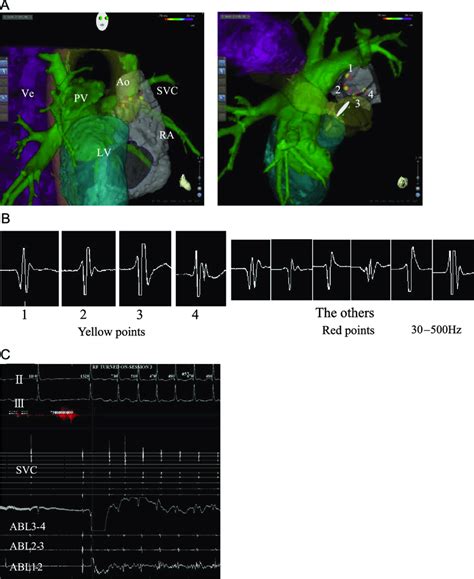 Catheter Ablation Using A Three Dimensional System A The Left Panel Download Scientific