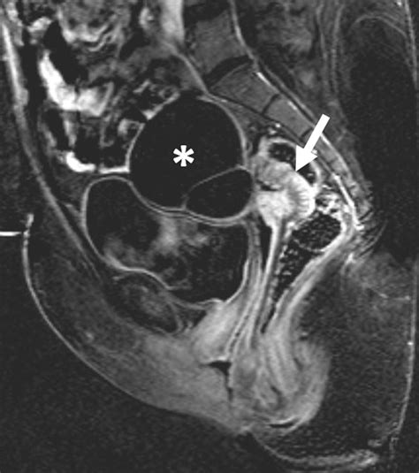 Imaging Of The Vagina Spectrum Of Disease With Emphasis On Mri