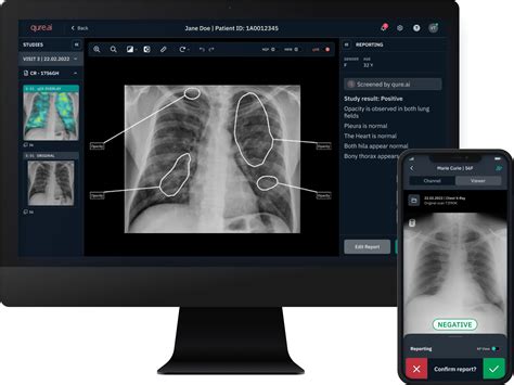 Radiologists Use Artificial Intelligence To Make Lung Cancer Easier To Detect Gadgetonus