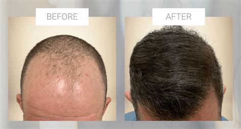 How Is Shave Less Fue Different From Traditional Fue