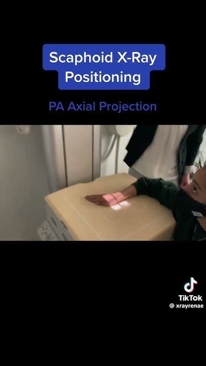 Scaphoid X Ray Positioning Youtube