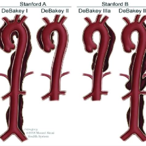 Classification Of Aortic Dissection 17 Download Scientific Diagram